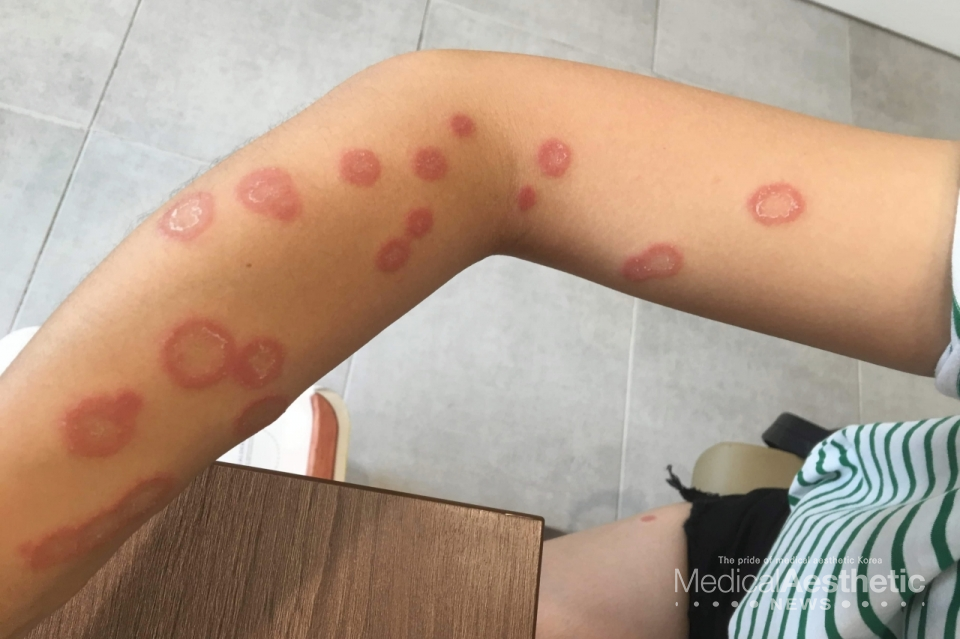 Be aware of fungus from head to toe, 'Trichophytosis'
