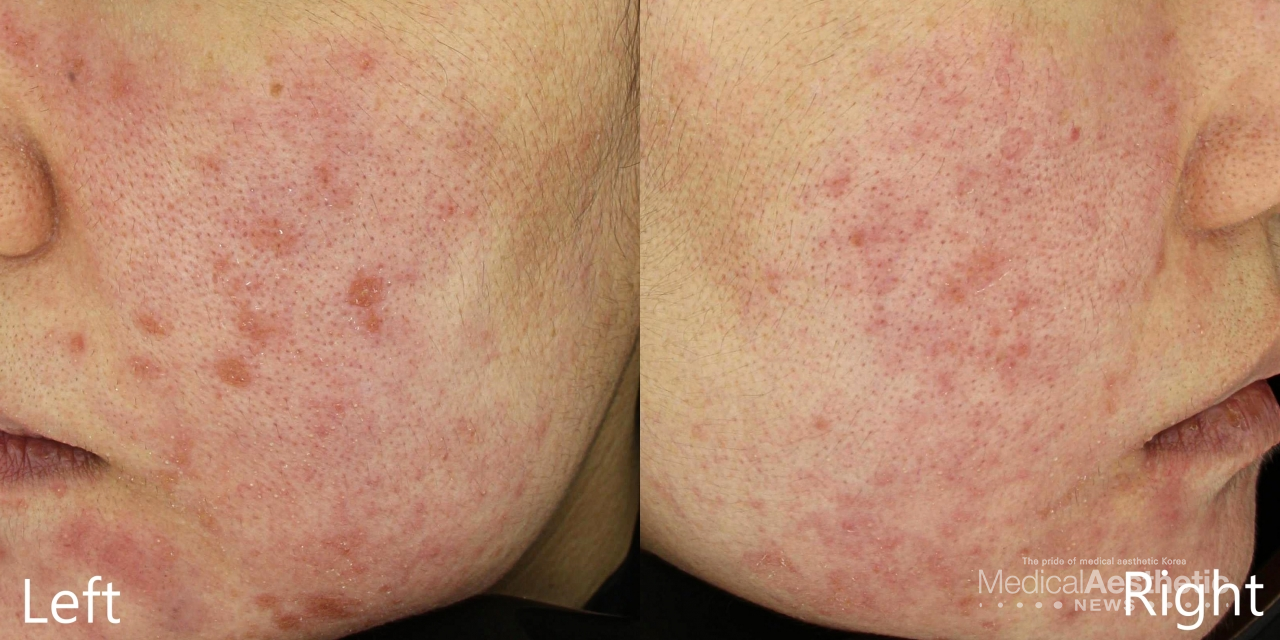 ‘Rosacea’ that Rudolph would cry too, strengthening the skin barrier ...